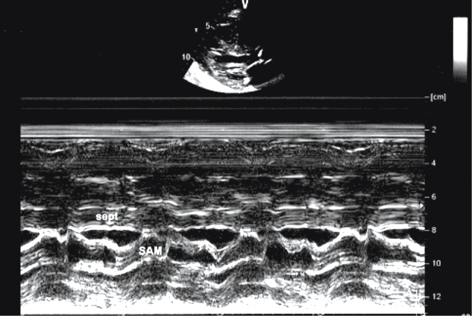 Hypertrophic obstructive cardiomyopathy and mitral valve abnormalities