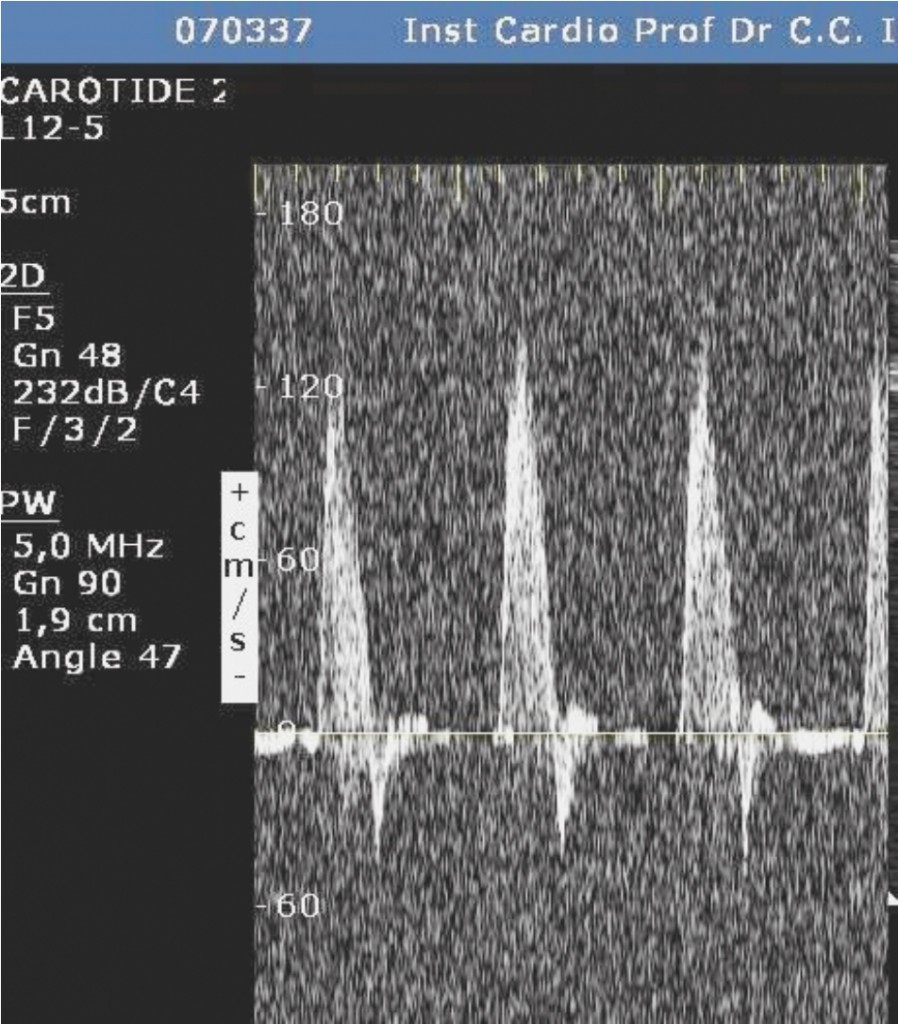 Vascular Doppler: Bilateral stenosis of the internal carotid arteries