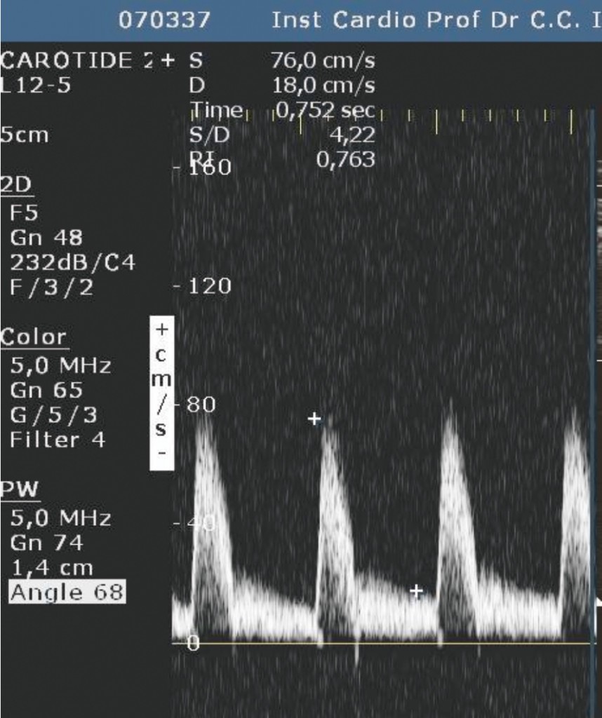 Vascular Doppler: Bilateral stenosis of the internal carotid arteries