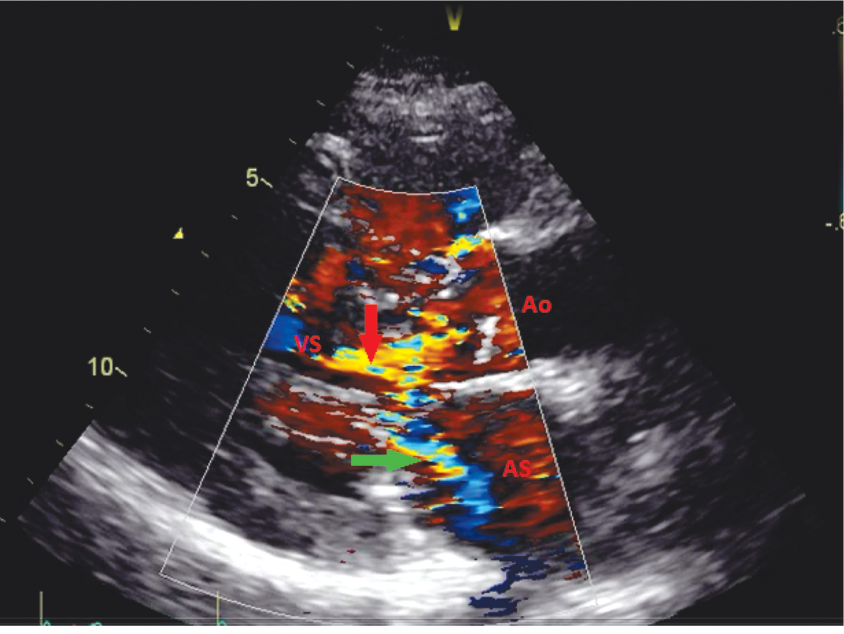 Hypertrophic obstructive cardiomyopathy and mitral valve abnormalities