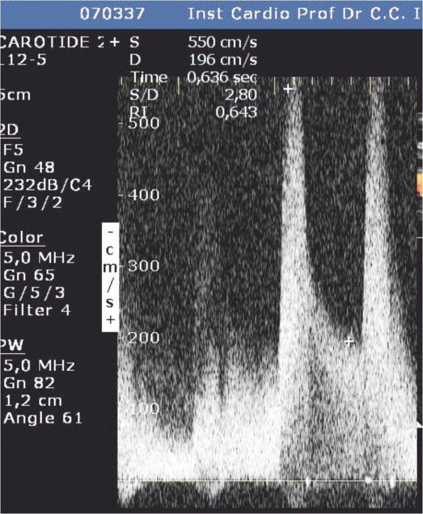 Vascular Doppler: Bilateral stenosis of the internal carotid arteries