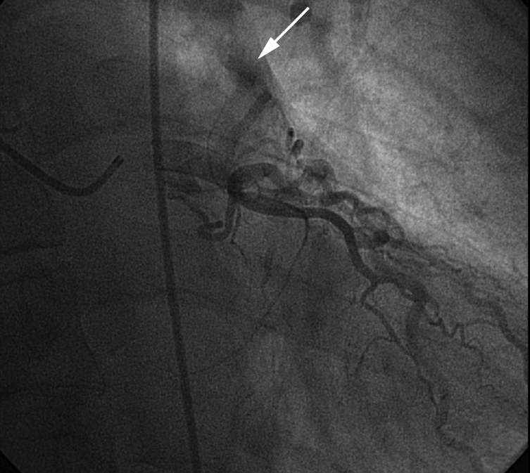 Coronary artery fistula visualized with computed tomography angiography