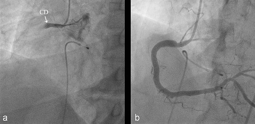 Coronary spasm – A rare case of acute myocardial infarction