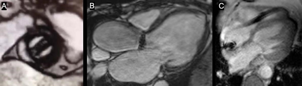 Update on MRI safety in patients with stents, prosthetic heart valves ...