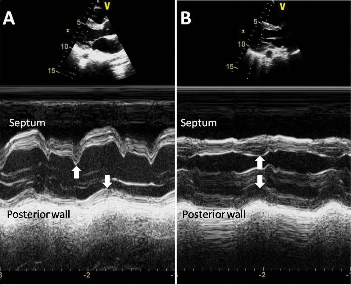 Cardiac resynchronization therapy in a child with tetralogy of Fallot