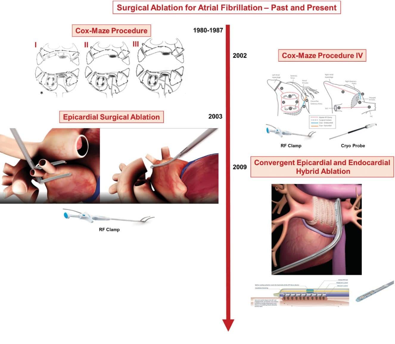 Atrial fibrillation ablation – from surgery to radiofrequency, cryo and ...