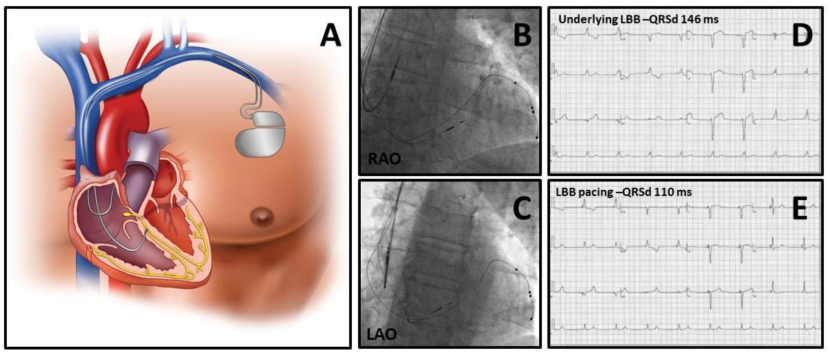 Left bundle branch pacing: the new kid on the block